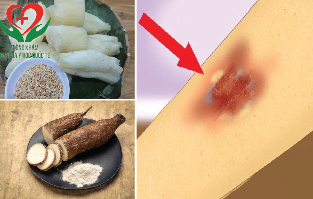 Ăn khoai mì có bị mưng mủ không?